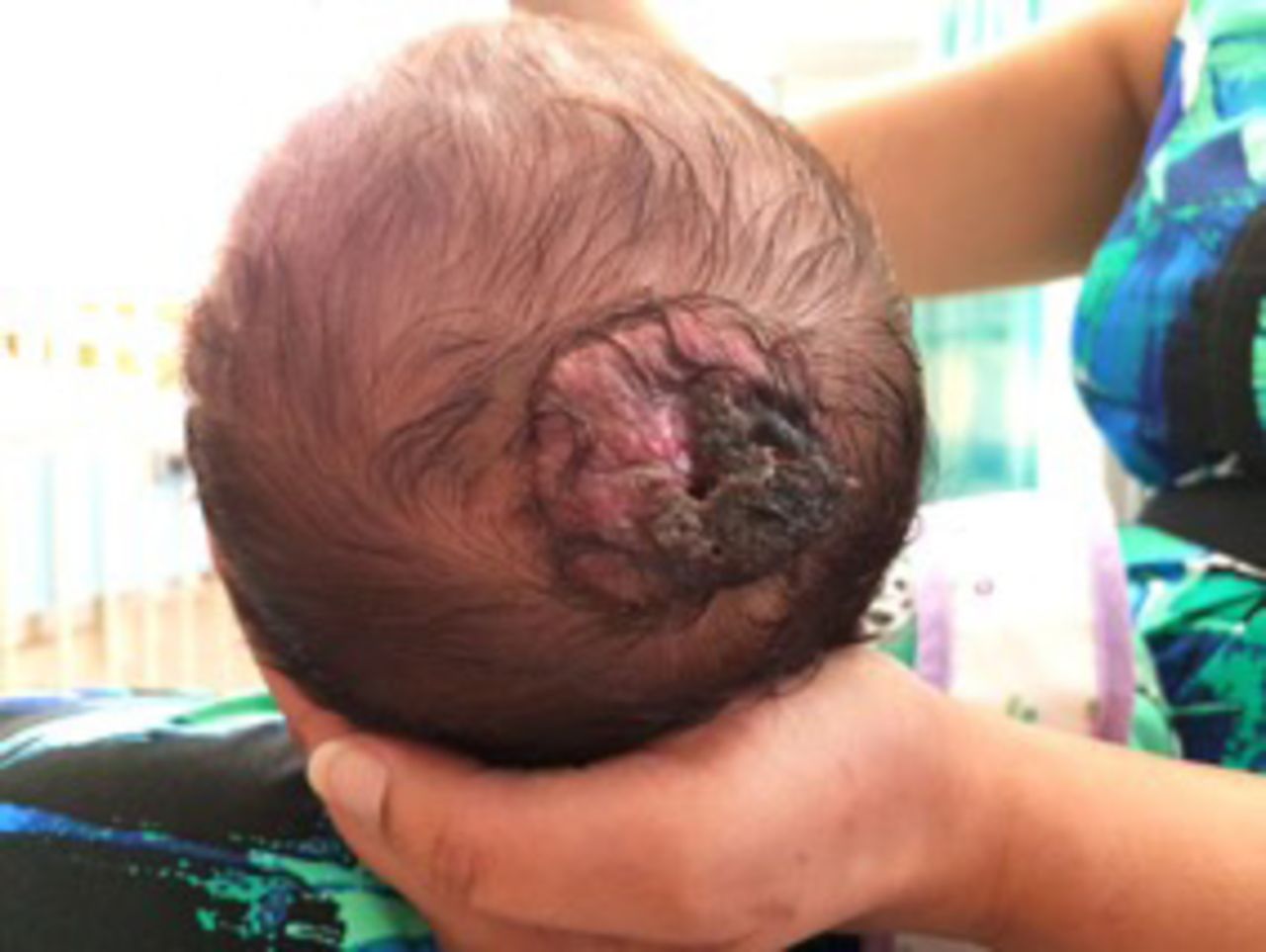 Qué es la necrosis: tipos y qué debes hacer si te pasa