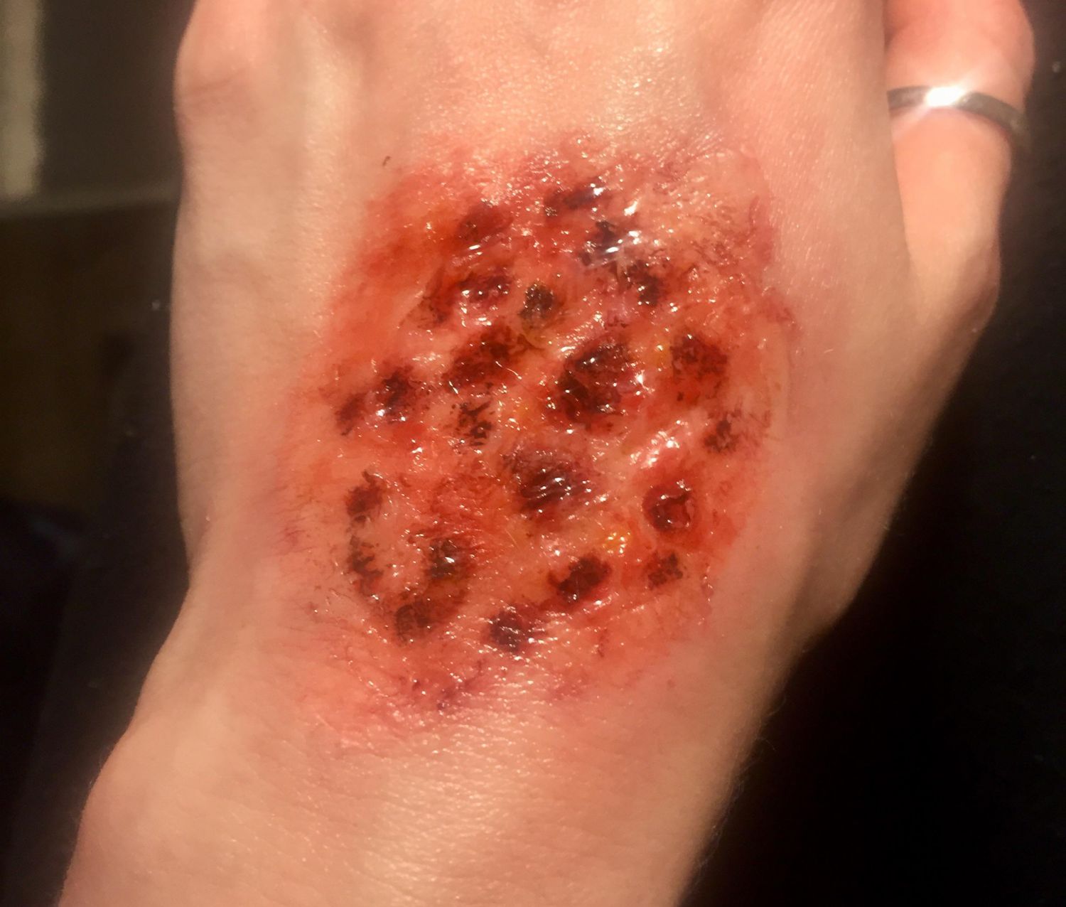 Qué es la necrosis: tipos y qué debes hacer si te pasa