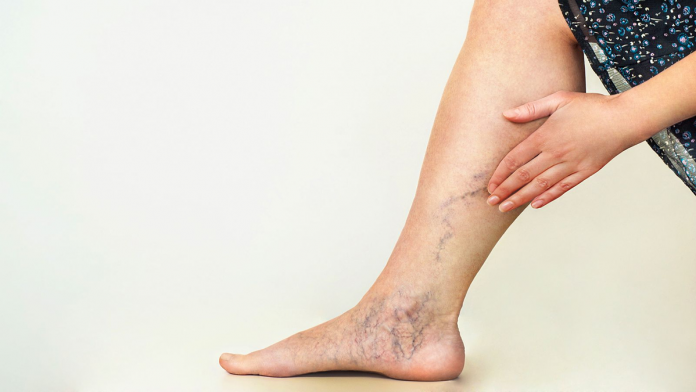 Qué es la flebitis