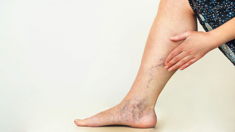 Qué es la flebitis